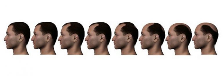 Les différents symptômes de la calvitie selon Norwood-Hamilton